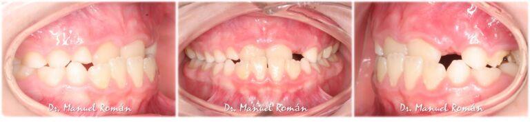 Caso clinico Placa Bertoni ortodoncia | manuelroman.com