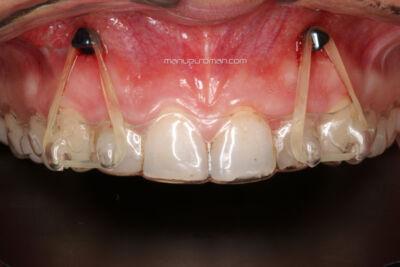 Masterclass de Microtornillos y Alineadores en Ortodoncia